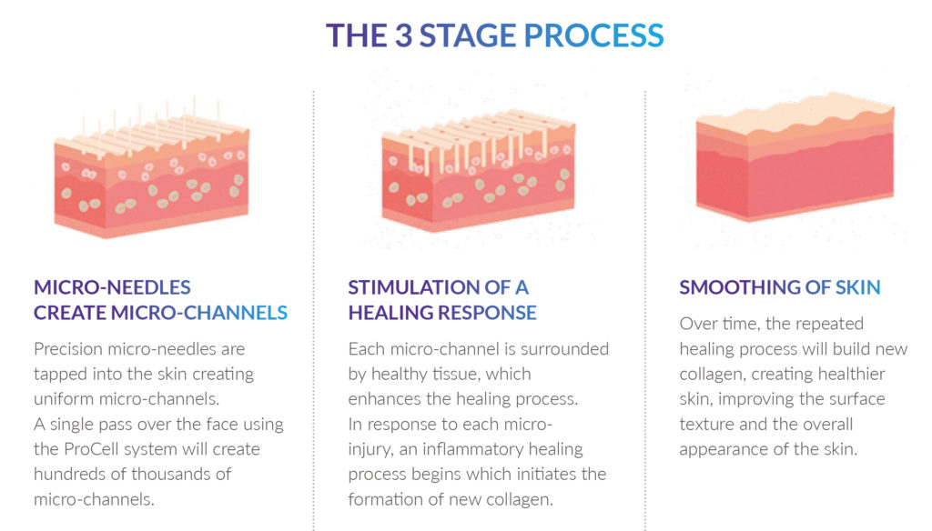 Procell MicroChanneling in Virginia Beach